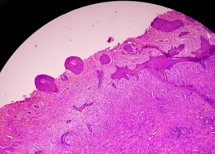 Biopsia De Piel Bajo Microscopía Sugestiva De Carcinoma De Células