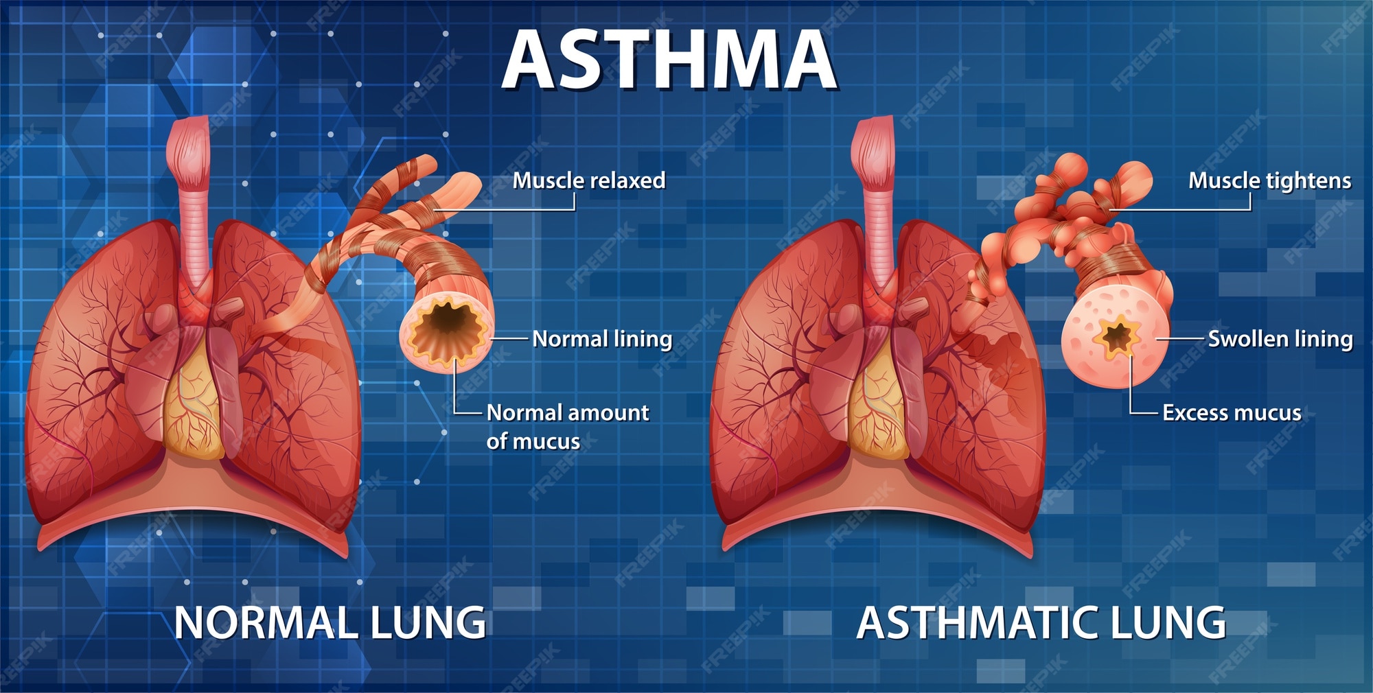 Real Lungs With Asthma