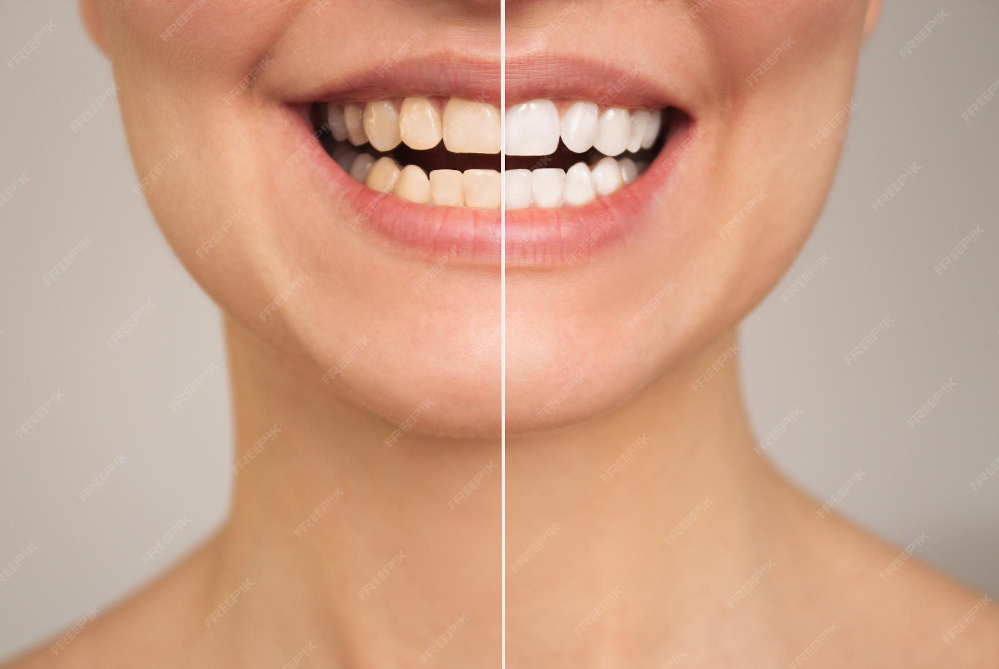 Premium Photo Closeup Womens Teeth Before And After Whitening The Concept Of Comparison