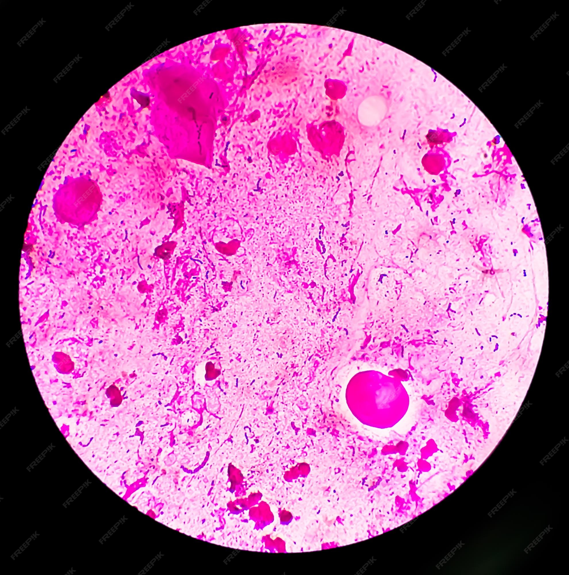 Premium Photo Gram Stain Gram Positive Cocci Or Gram Positive Diplococci Bacteria