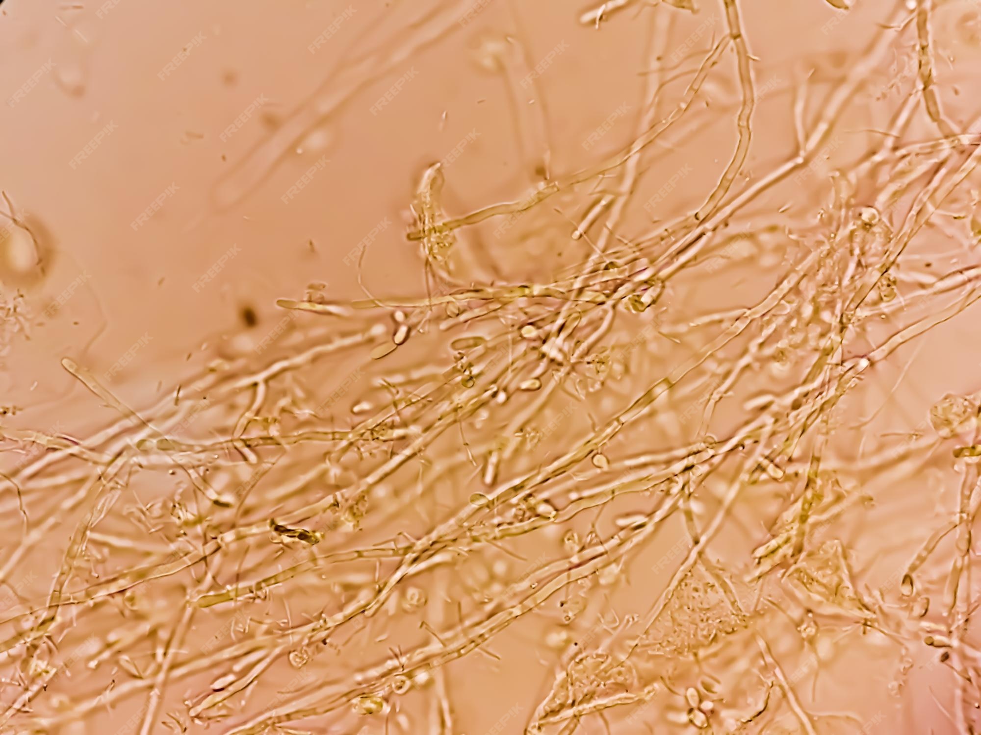 Premium Photo Pseudohyphae And Budding Yeast Cells In Patient Urine Urinary Tract Infections