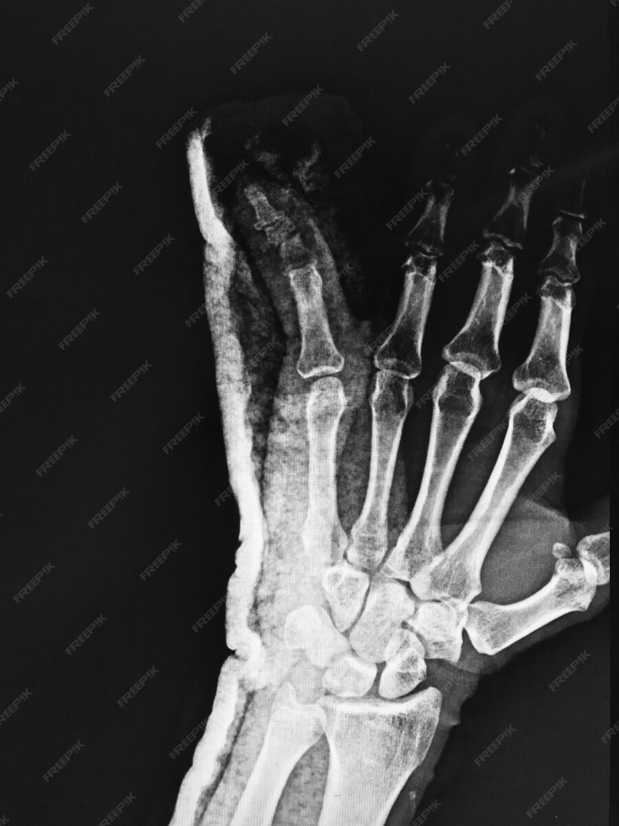 Premium Photo A Radiograph Of A Hand With A Bone Showing The Bones Of The Hand