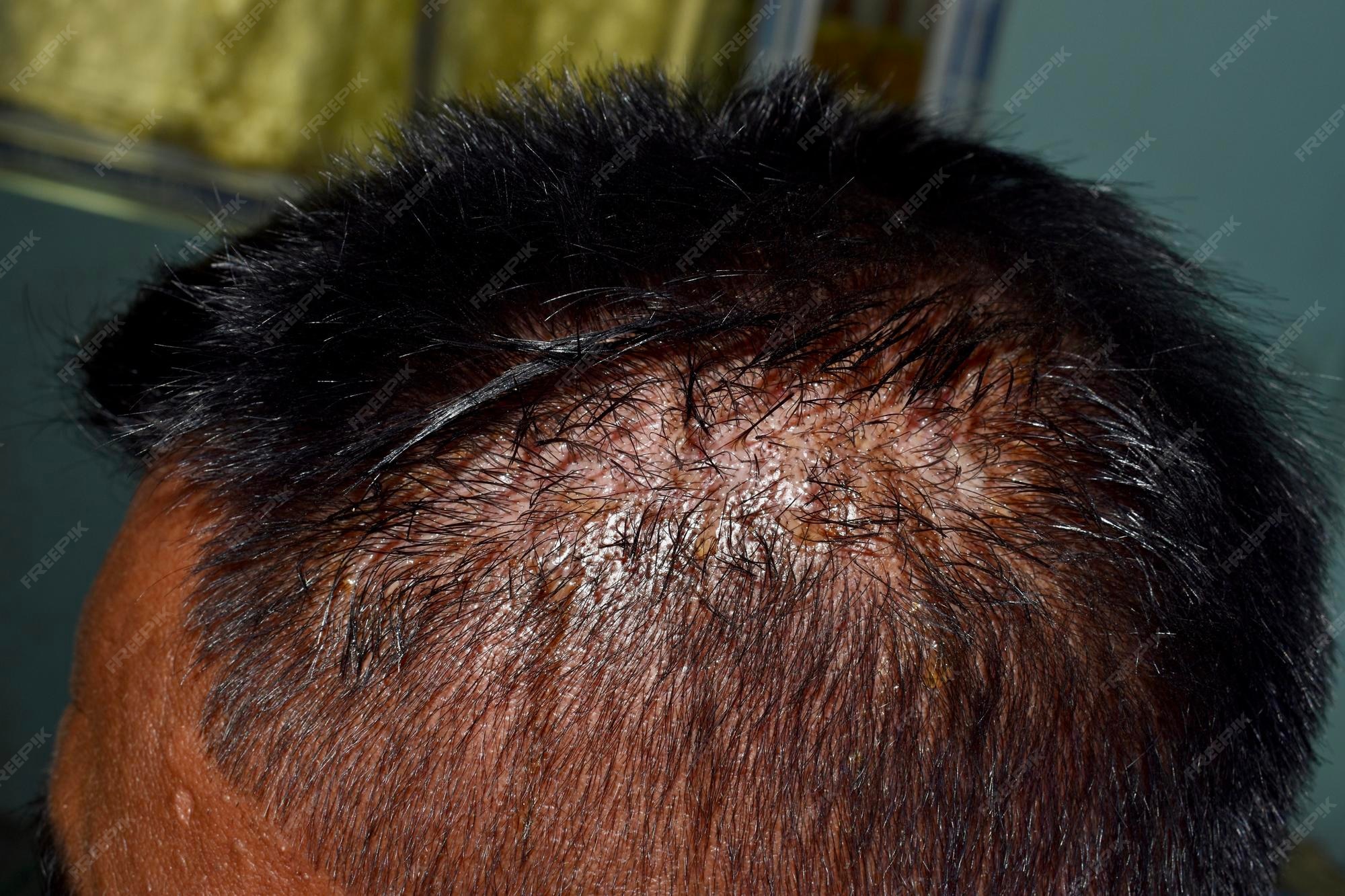 Premium Photo Seborrheic Dermatitis At The Scalp Of Southeast Asian Myanmar Adult Male Patient