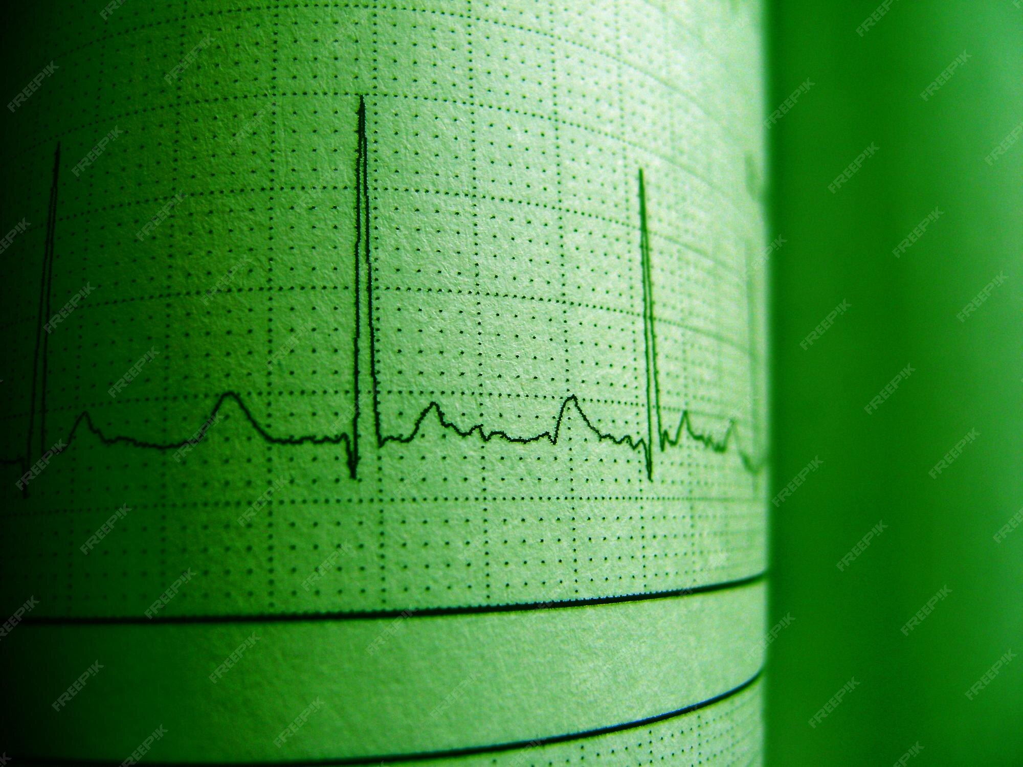 Premium Photo | Sinus Heart Rhythm On Electrocardiogram Record Paper ... Premium Photo | Sinus Heart Rhythm On Electrocardiogram Record Paper ...