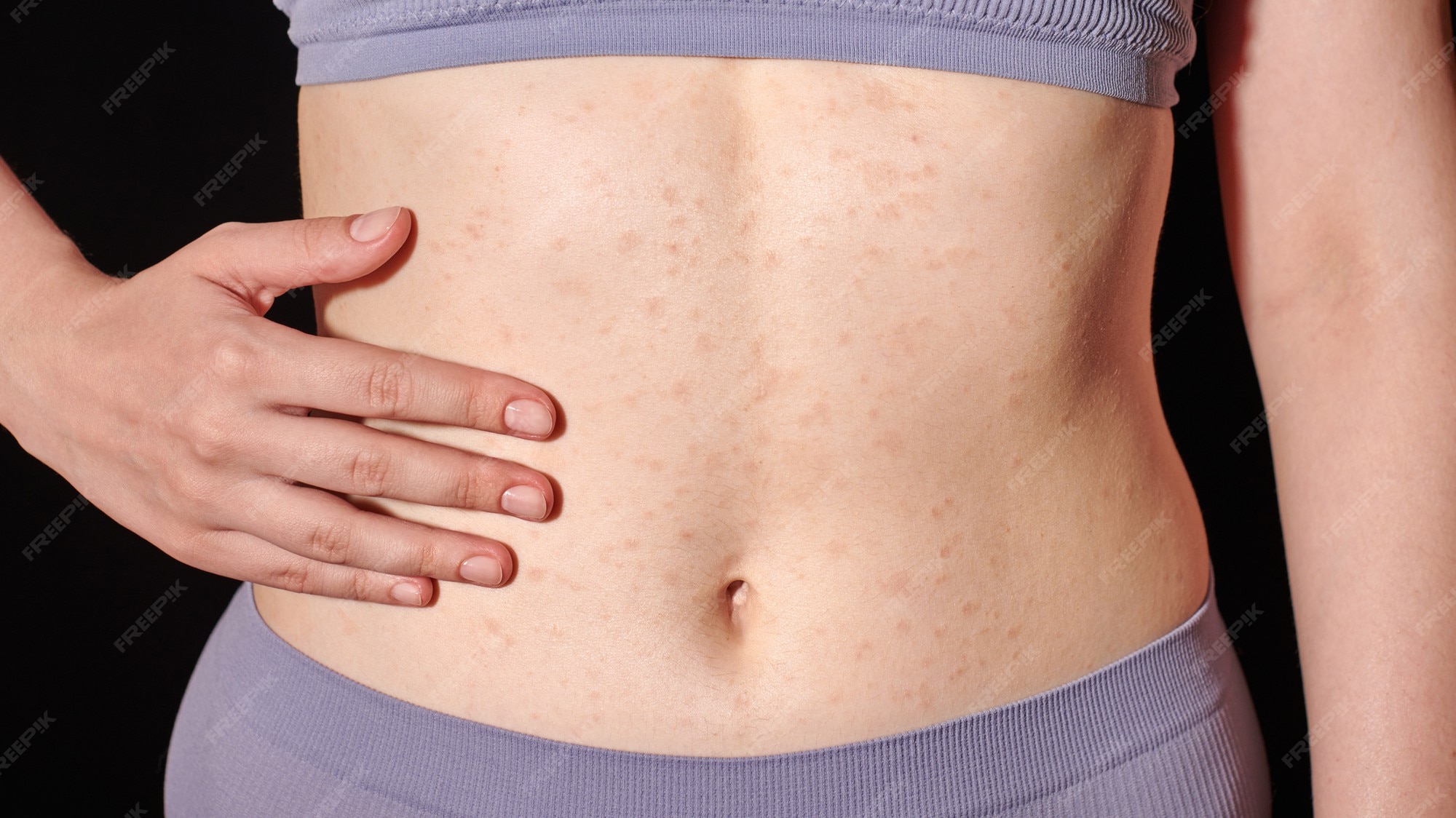 Itchy Rash On Stomach