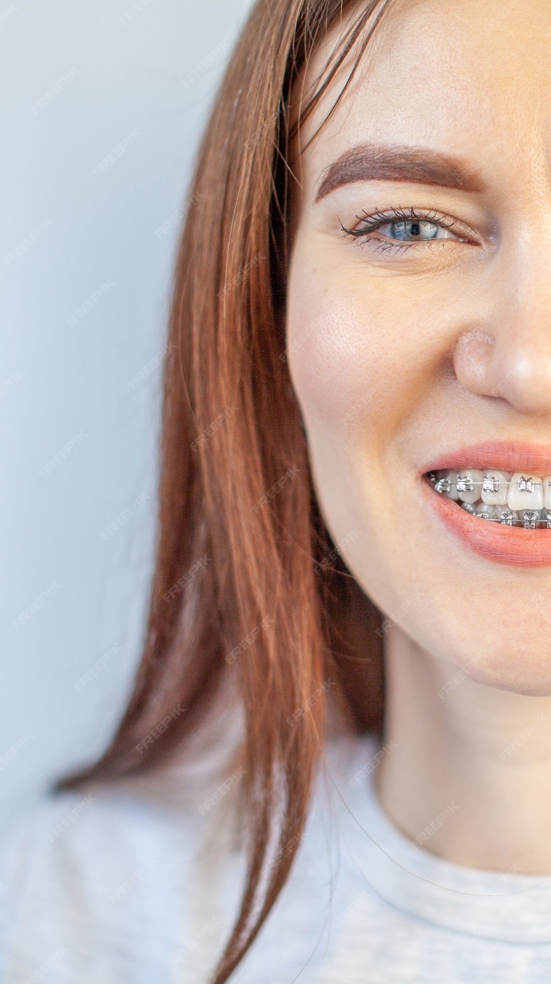 Beautiful People With Braces