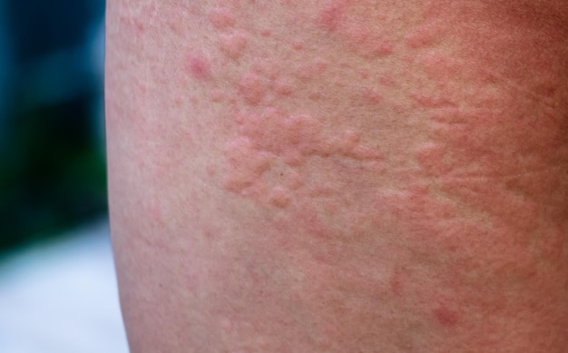 Red Skin Hives Pictures Freepik