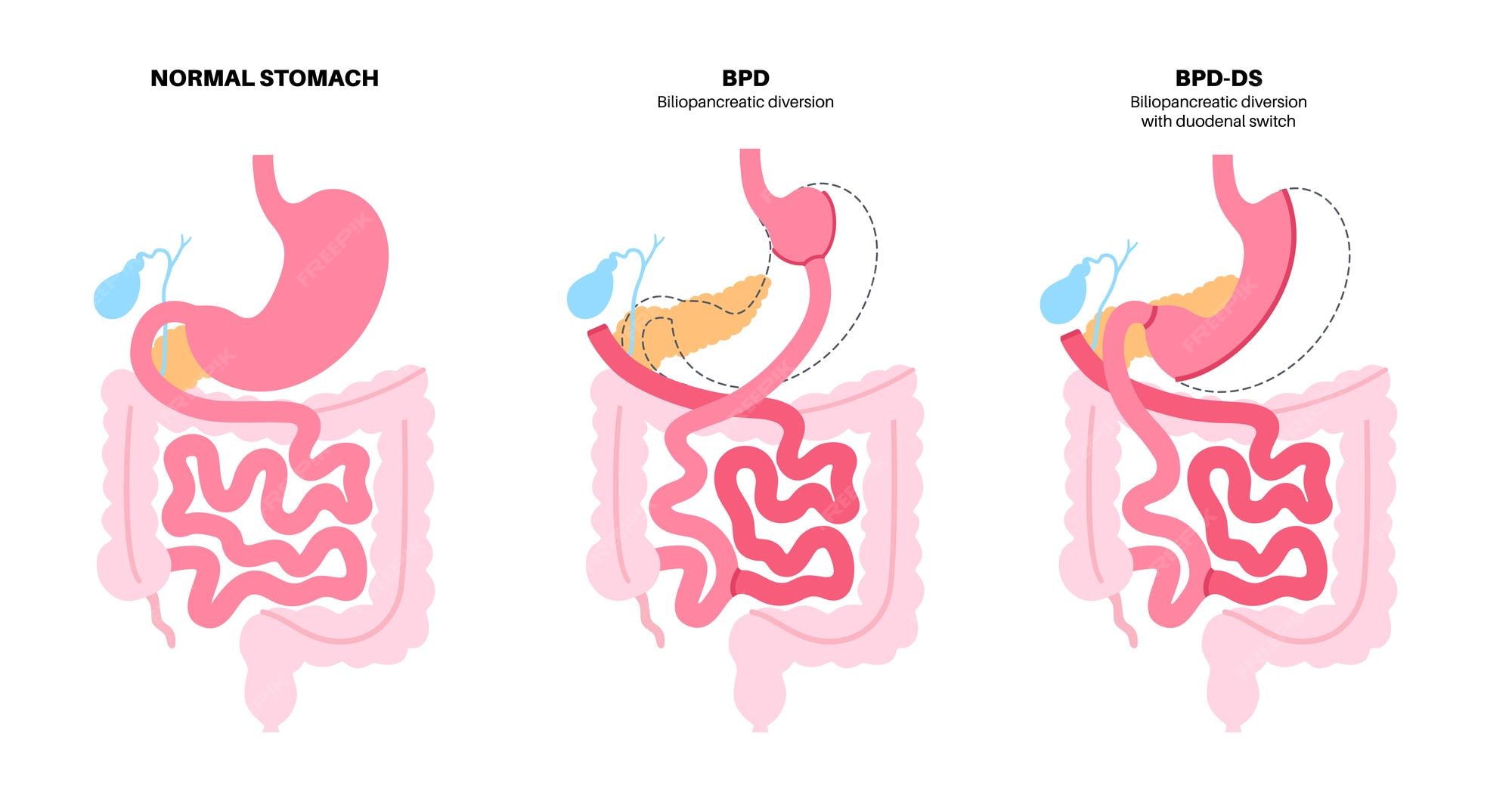 Biliopancreatic Diversion With Duodenal Switch Biliopancreatic Diversion With Duodenal Switch