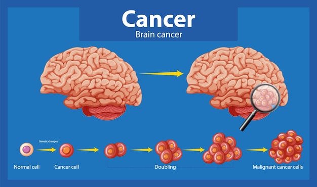 Premium Vector Brain Cancer And Abnormal Cell Growth Infographic