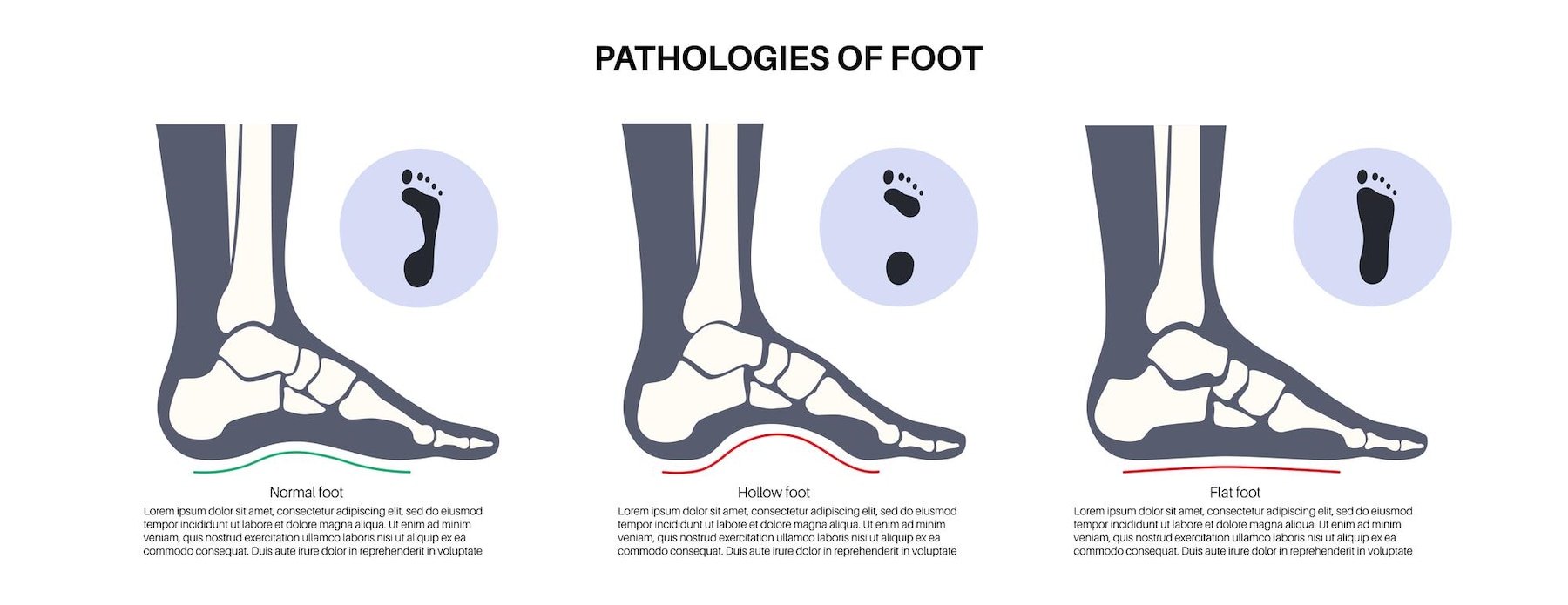 Premium Vector Foot Pathologies Anatomical Poster Flat Normal And Hollow Feet Conditions