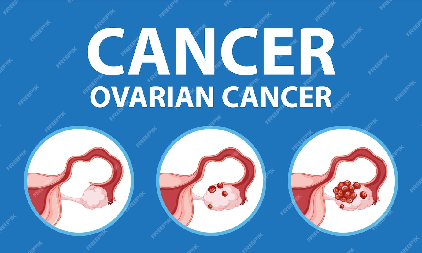 Premium Vector Illustrated Infographic Of Woman39s Ovarian Cancer Stages