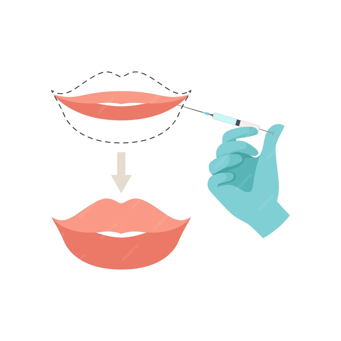 Premium Vector Lips Augmentation Procedure Hyaluronic Acid Lip Injections Vector Illustration