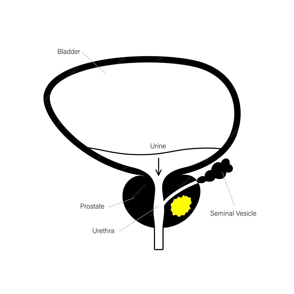 Premium Vector Prostate Cancer Concept