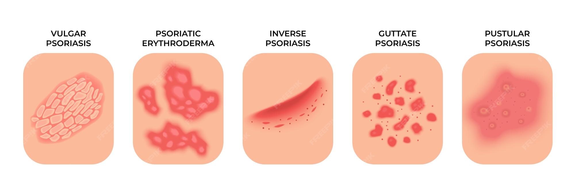 Premium Vector Psoriasis Allergic Eczema Types Rashes Treatment Dermatology Infectious Spots