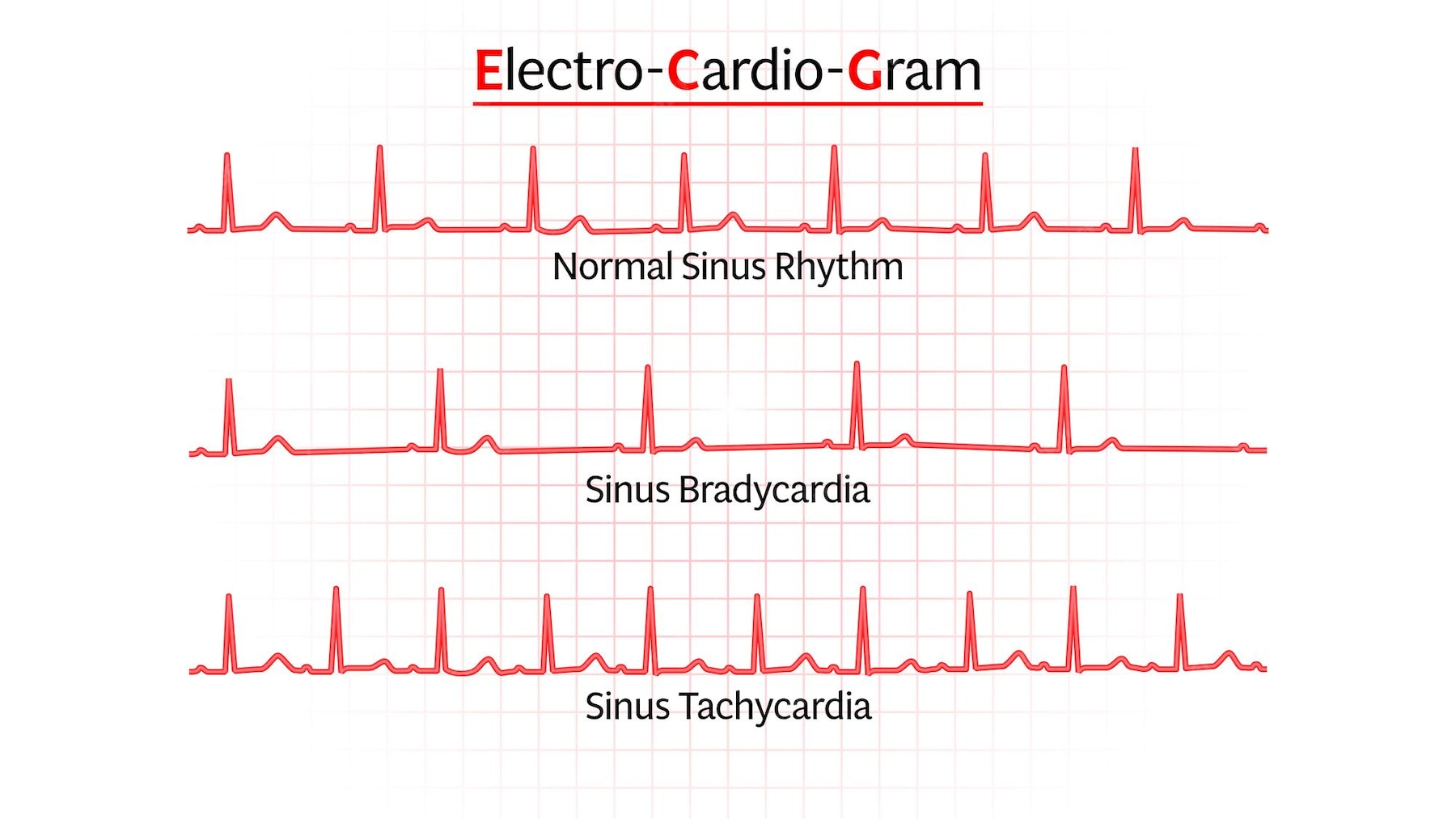Premium Vector | Set of ecg common case normal sinus rhythm sinus ... Premium Vector | Set of ecg common case normal sinus rhythm sinus ...