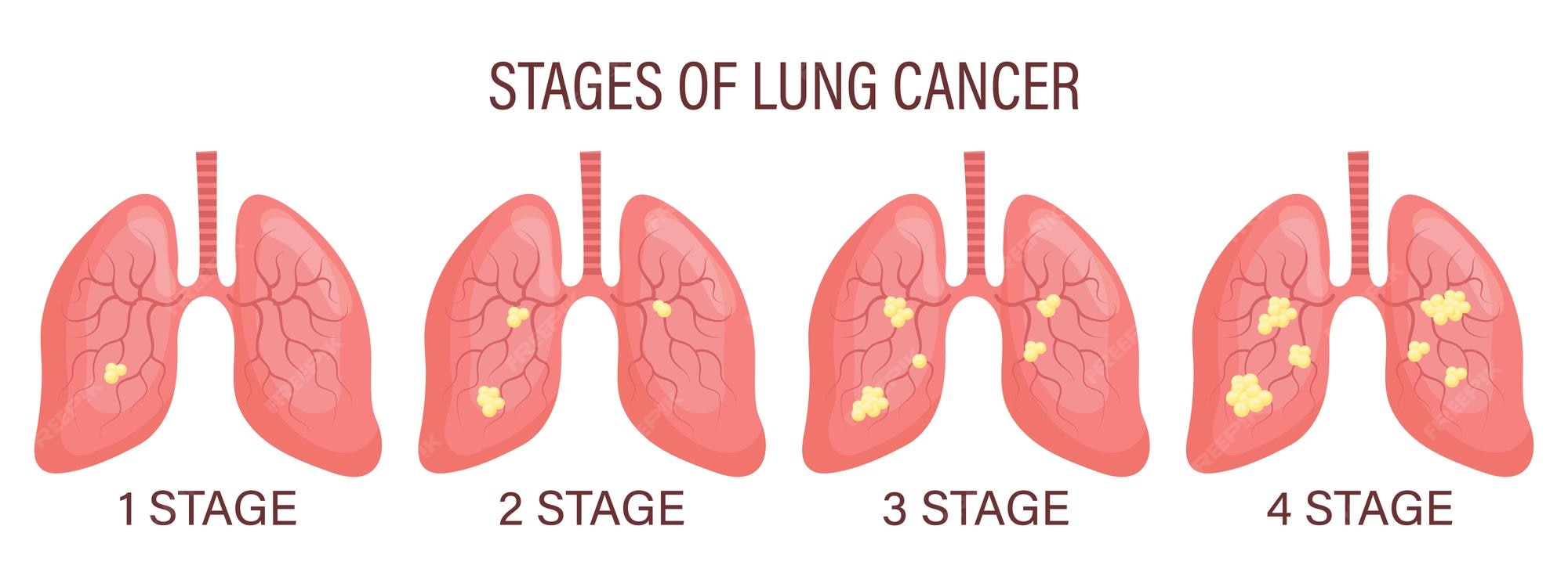 Premium Vector Stages Of Lung Cancer Lung Disease Medical Infographic Banner Illustration Vector
