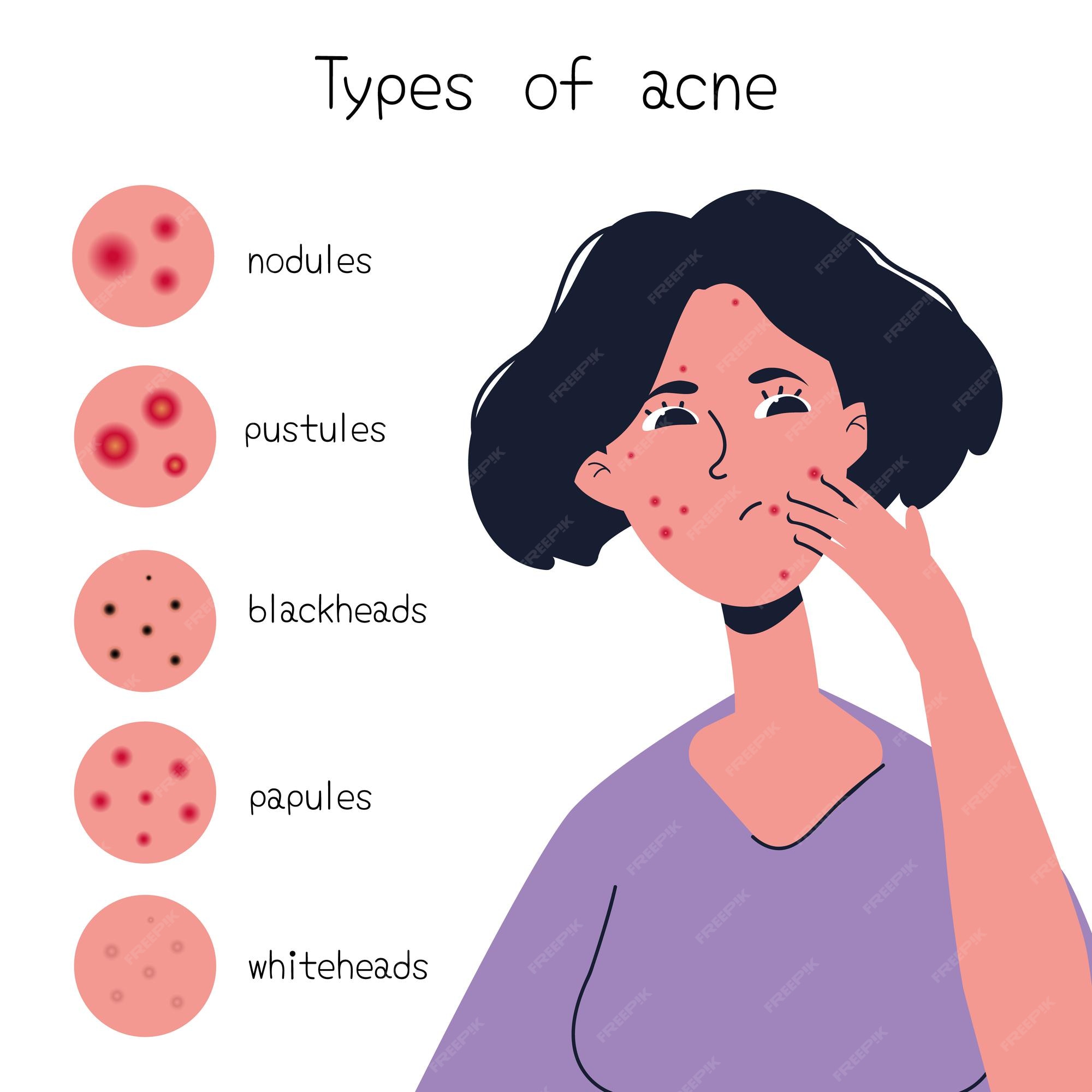 Premium Vector Types Of Acne Diagram