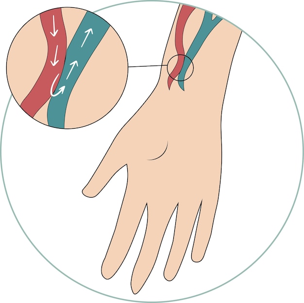 Premium Vector | Vascular Access Premium Vector | Vascular Access