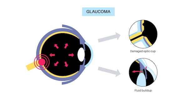 Enfermedad Ocular Del Glaucoma Vector Premium