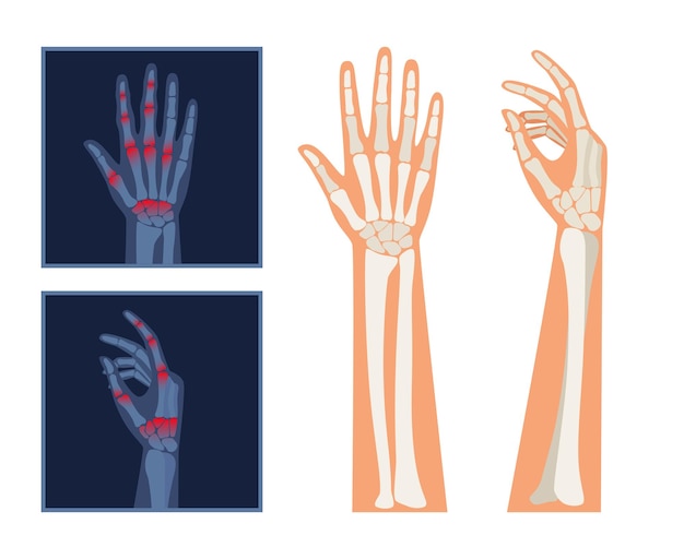 Arthritis-vektor-illustration der finger rheumatoide arthritis hände x ... Arthritis-vektor-illustration der finger rheumatoide arthritis hände x ...